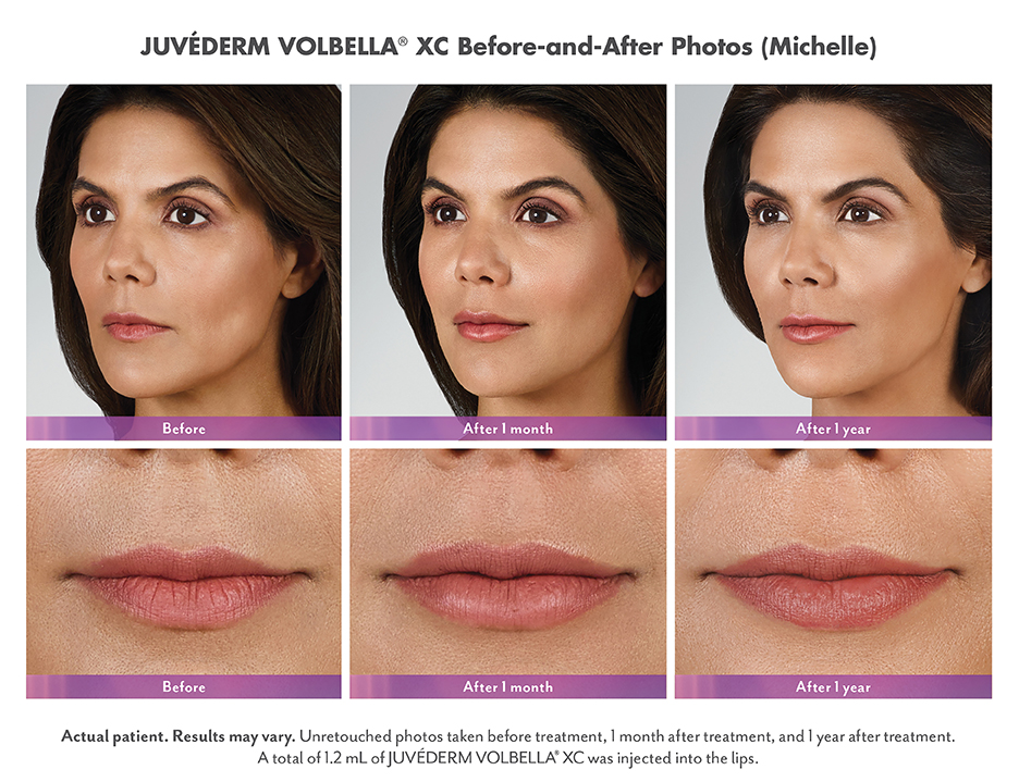 Shrinking Lips - Redwood Aesthetic Medicine