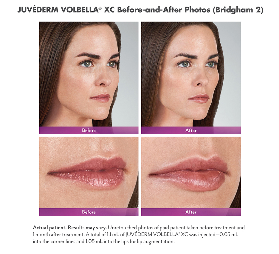 Shrinking Lips - Redwood Aesthetic Medicine