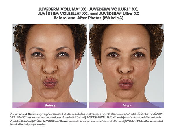 Shrinking Lips - Redwood Aesthetic Medicine